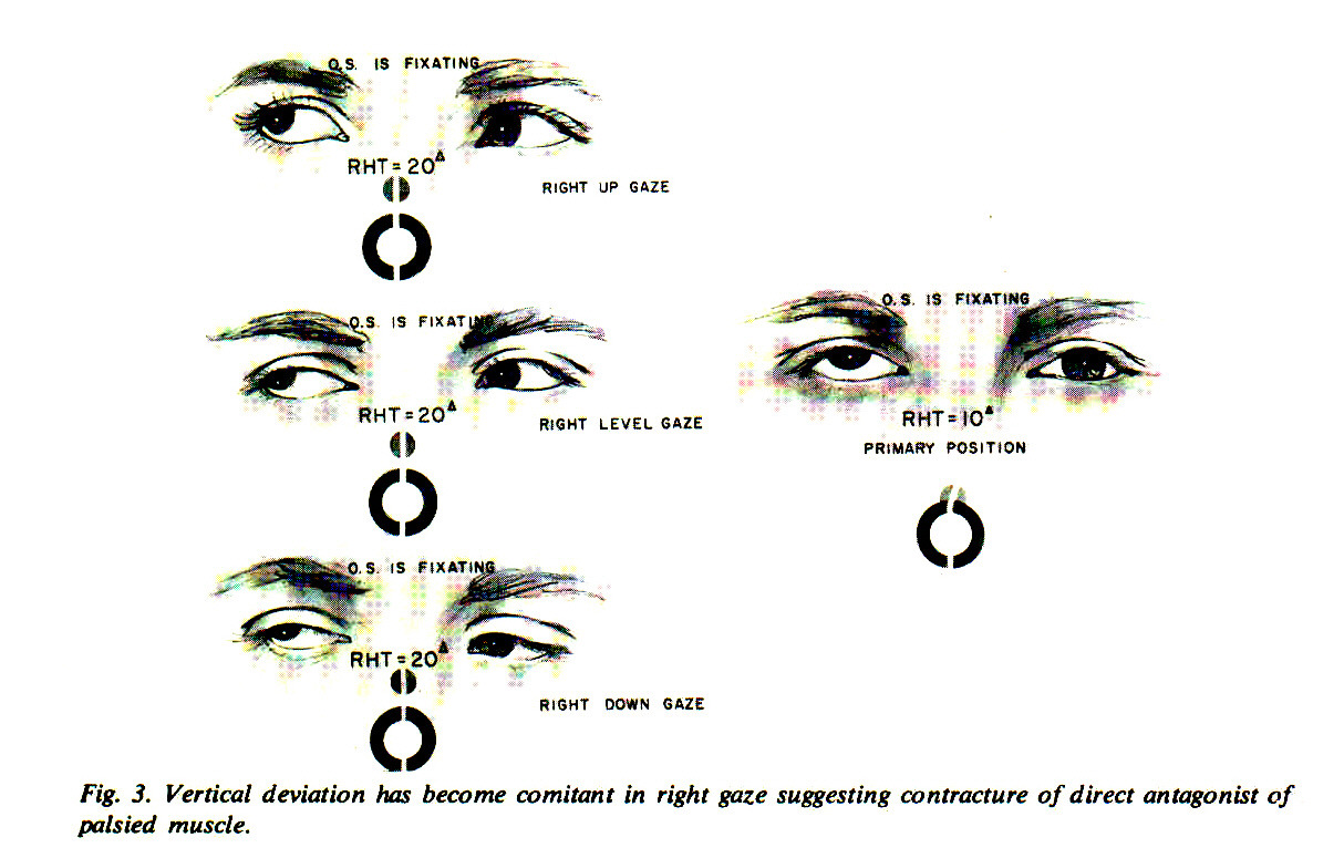 Surgical Management of Isolated Cyclovertical Muscle Palsy